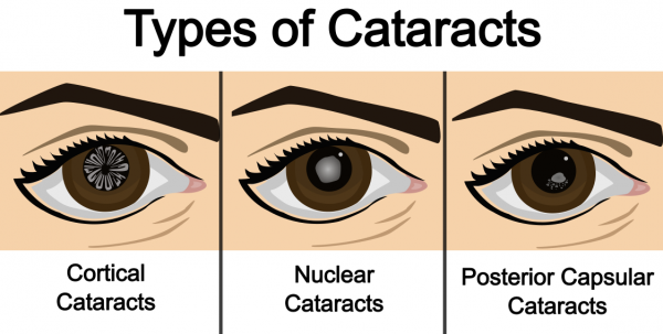 Types Of Cataract Patientsengage
